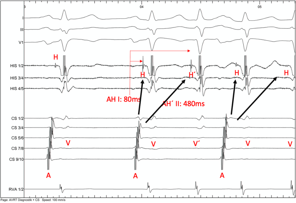 Special Case – AG Elektrophysiologie und Rhythmologie